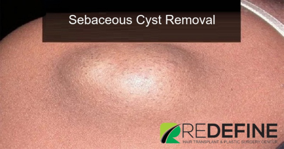 Sebaceous Cyst Removal In Hyderabad | Sebaceous Cyst Removal Surgery Cost